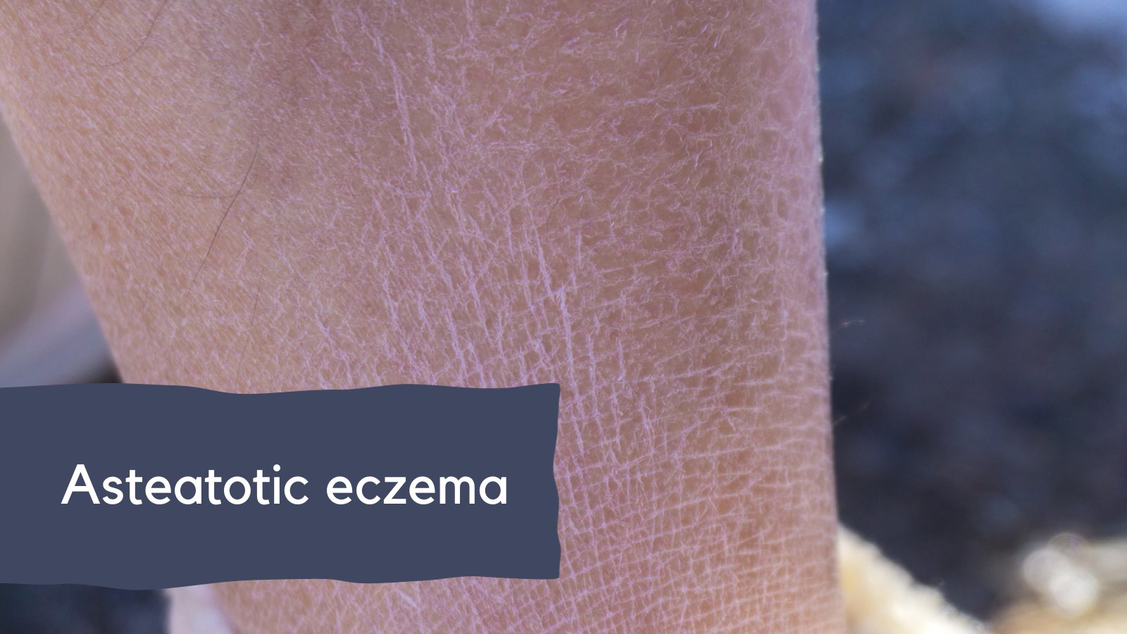 Eczema On Shins