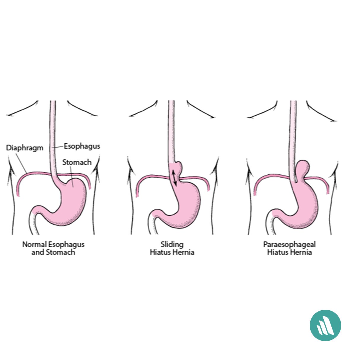 Paraesophageal Hiatal Hernia