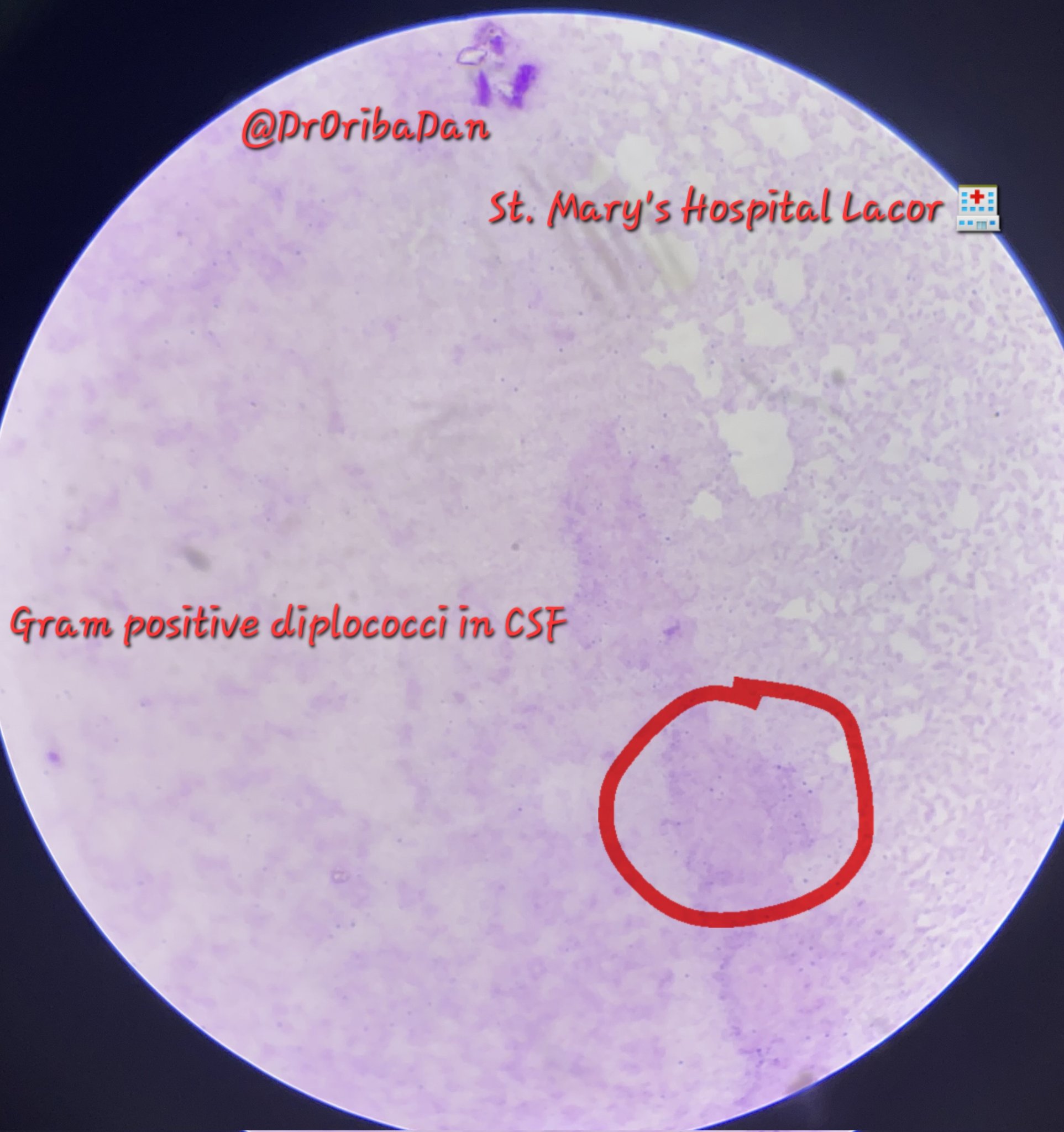 Diplococci Gram Positive