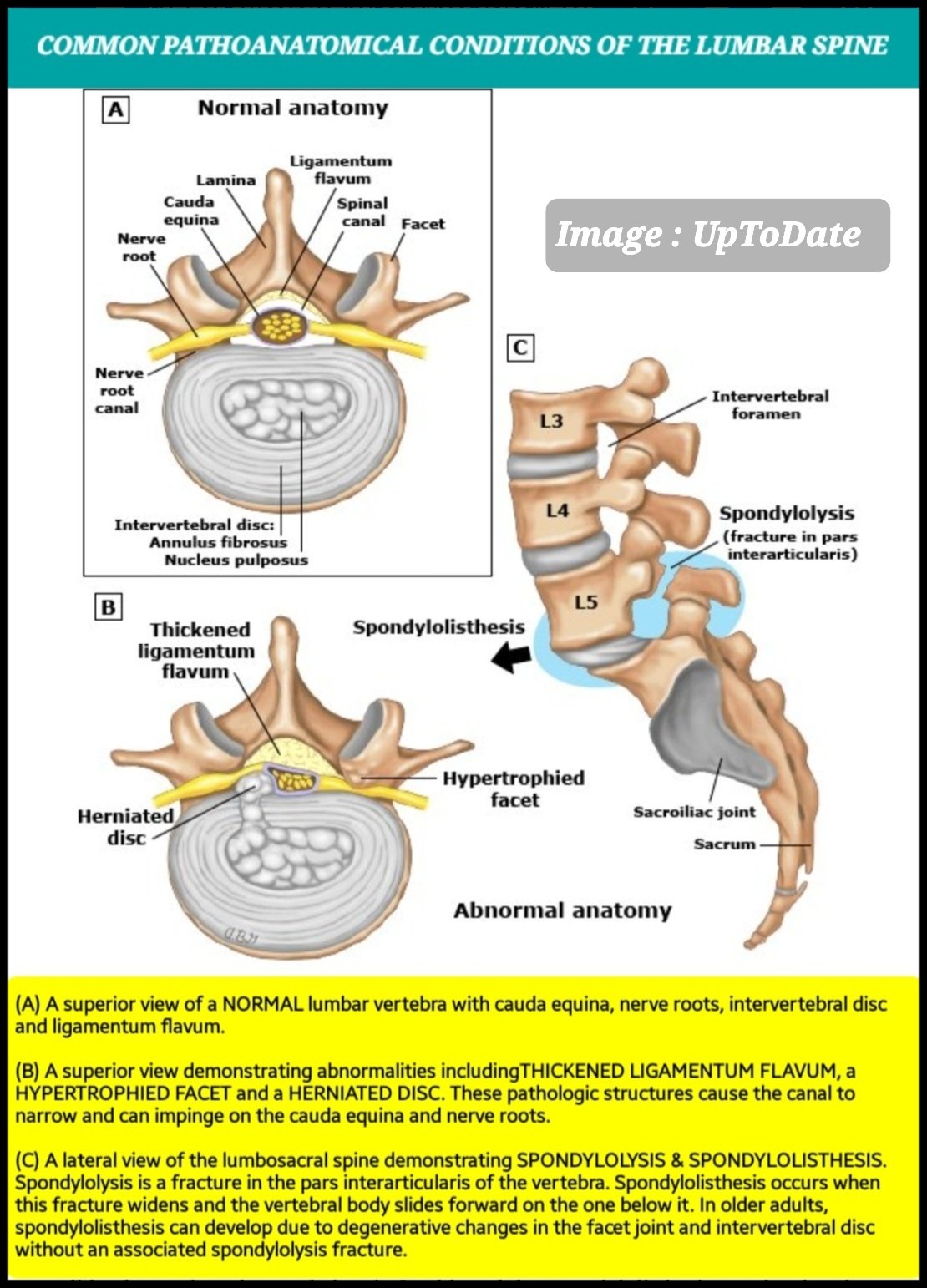 Neural Foramen