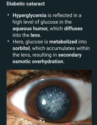 Snowflake Cataract Patient Education – Kamal Eye Clinic