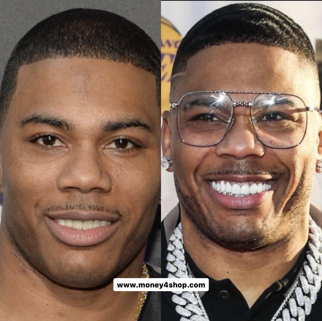 Nelly Before And After Teeth