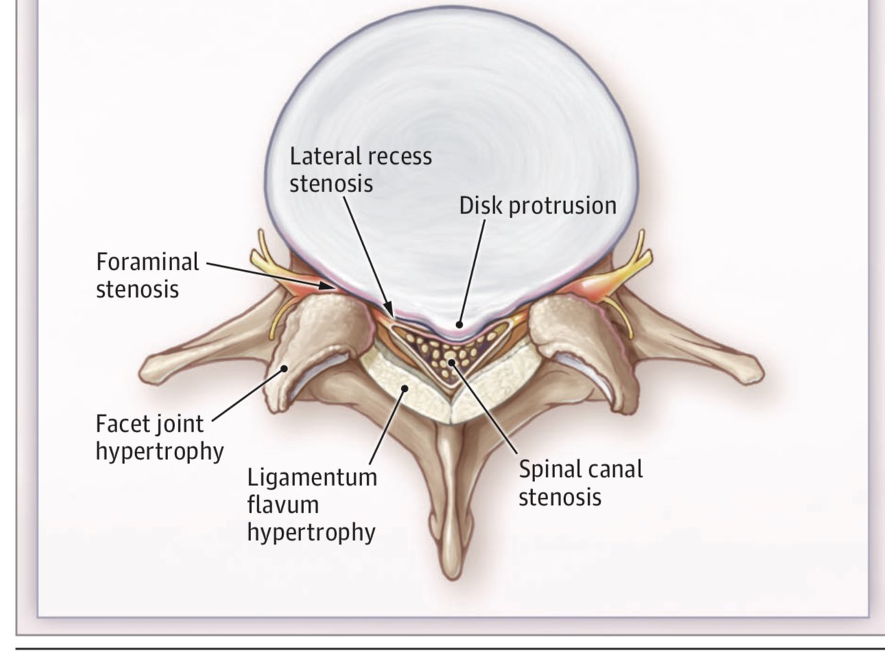 Lumbar Foraminal Stenosis