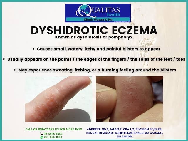 Itebimien Peter on Twitter: "@Sthanu5 Dyshidrotic eczema(also called pompholyx) A condition in ...