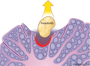 Tonsil Stones Diagram