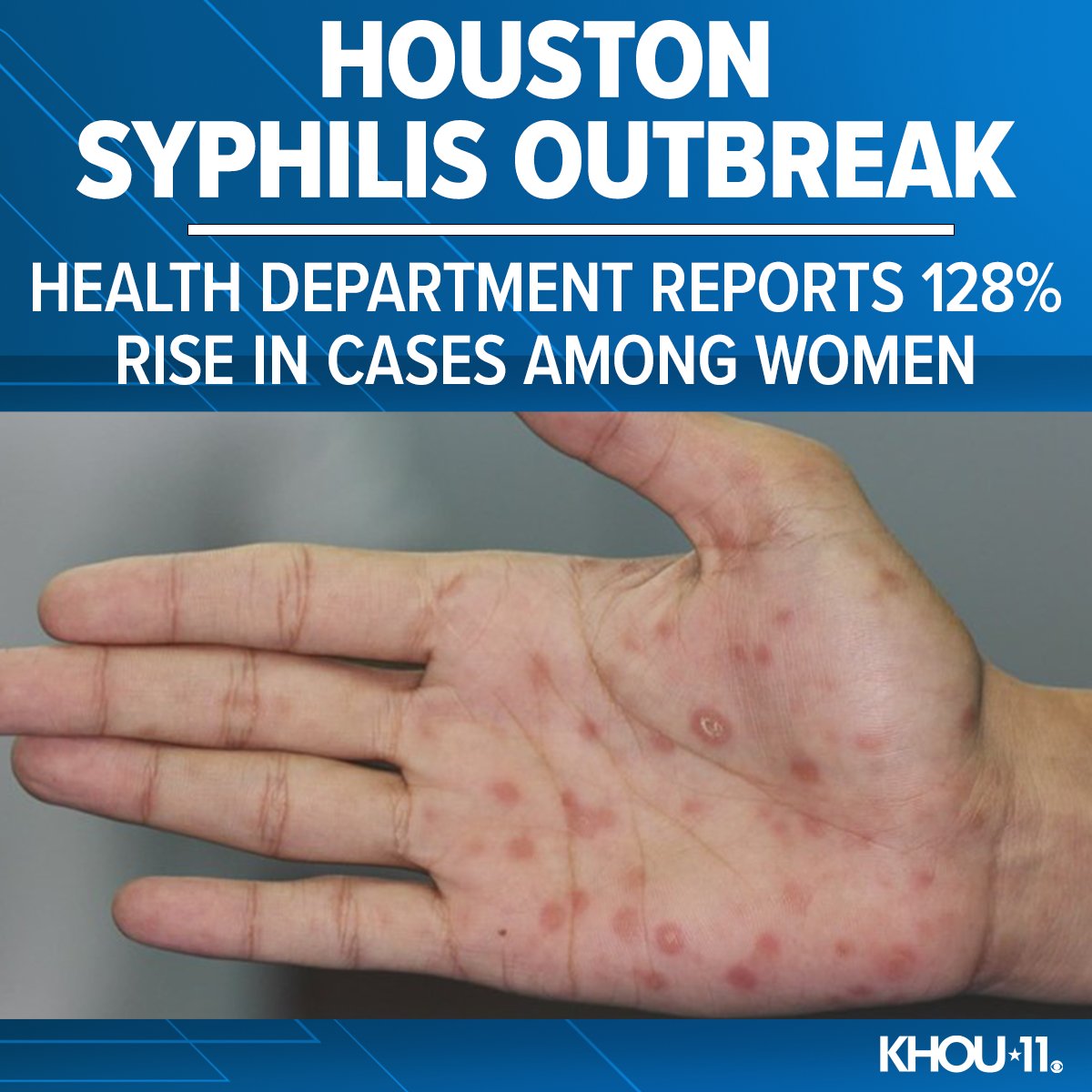 Syphilis On Women