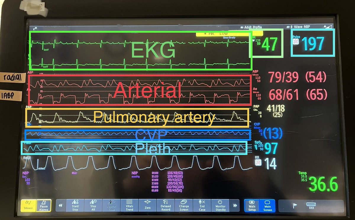 Waveform Quiz: what’s the actual HR and what are the sources of ...