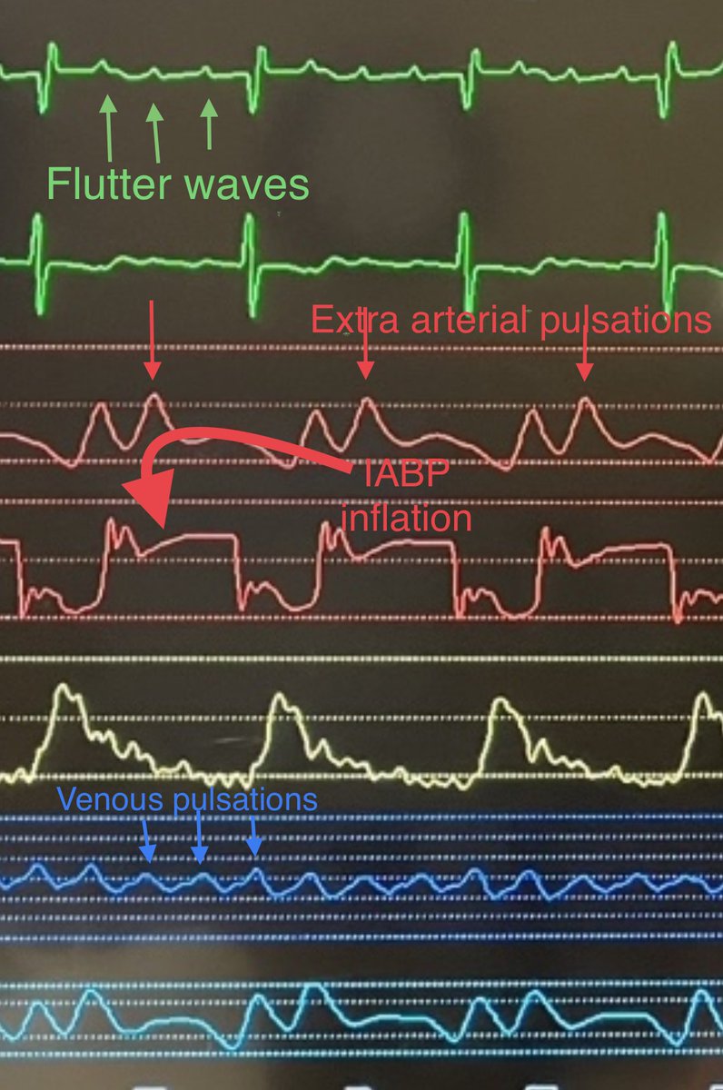 Waveform Quiz: what’s the actual HR and what are the sources of ...
