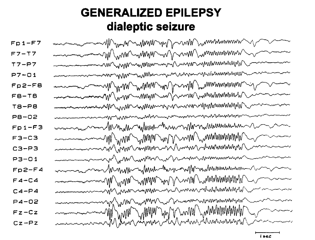 SEIZURE SEMIOLOGY #TWEETORIAL 🧵1/ What is a dialeptic seizure ...