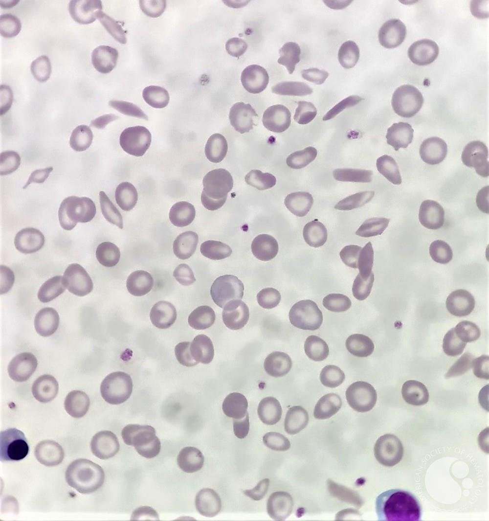 Sickle Cell Blood Smear