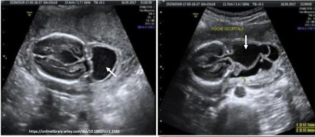 Encephalocele Ultrasound