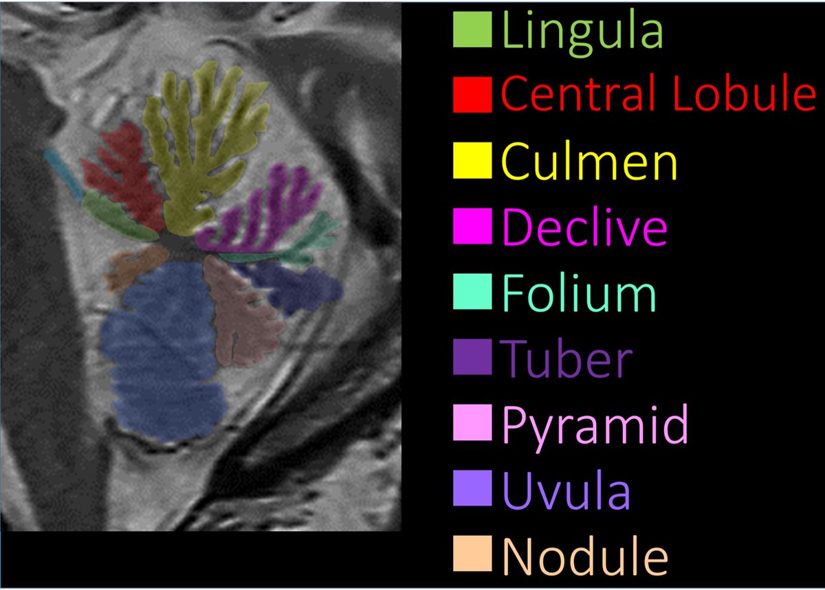 1/Is remembering cerebellar anatomy making you dizzy? Need help telling ...