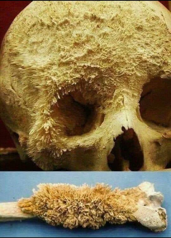 Bone Cancer Skull