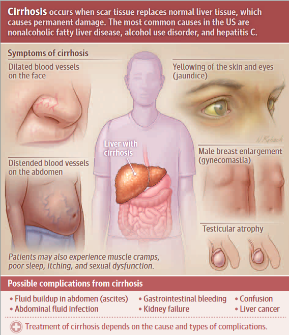 Liver Cirrhosis Symptoms Skin