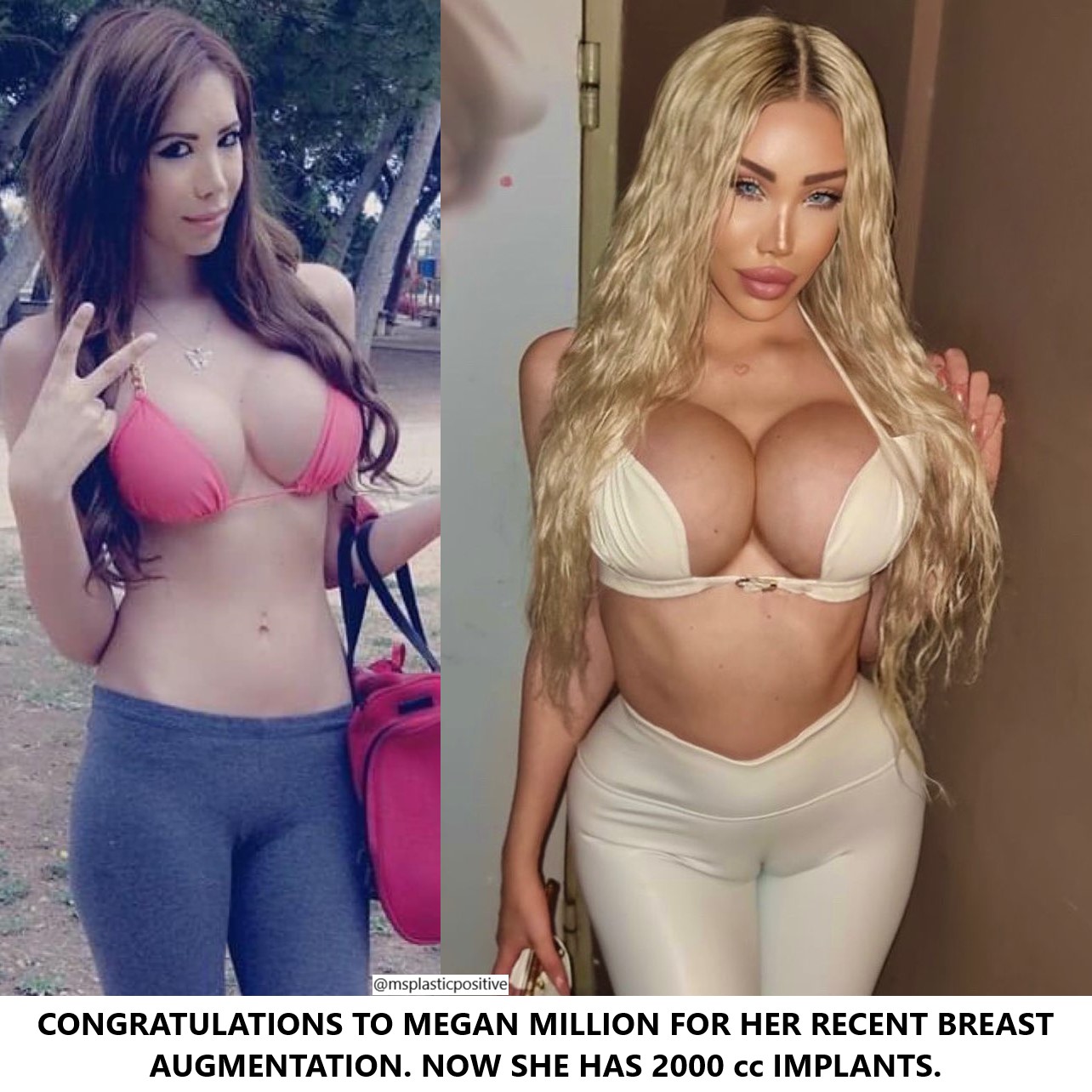 Ms Plastic Positive on Twitter: "Follow @meganmillion_ #BreastAugmentation #breastimplants # ...