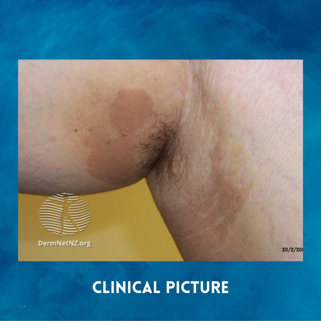 Dermnet Nz DermNet (@dermnetnz) / X