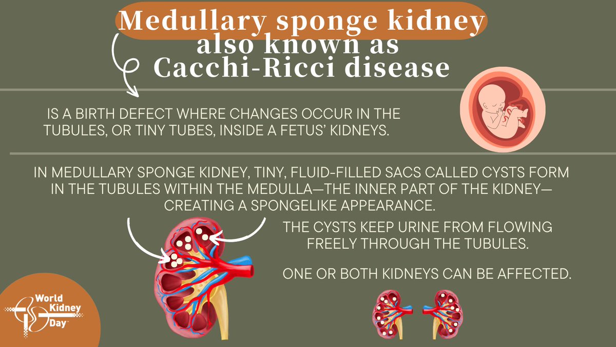 Medullary Sponge Kidney Medullary Sponge Kidney, Ct Scan By Science