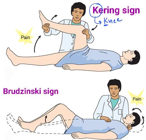 Brudzinski Sign