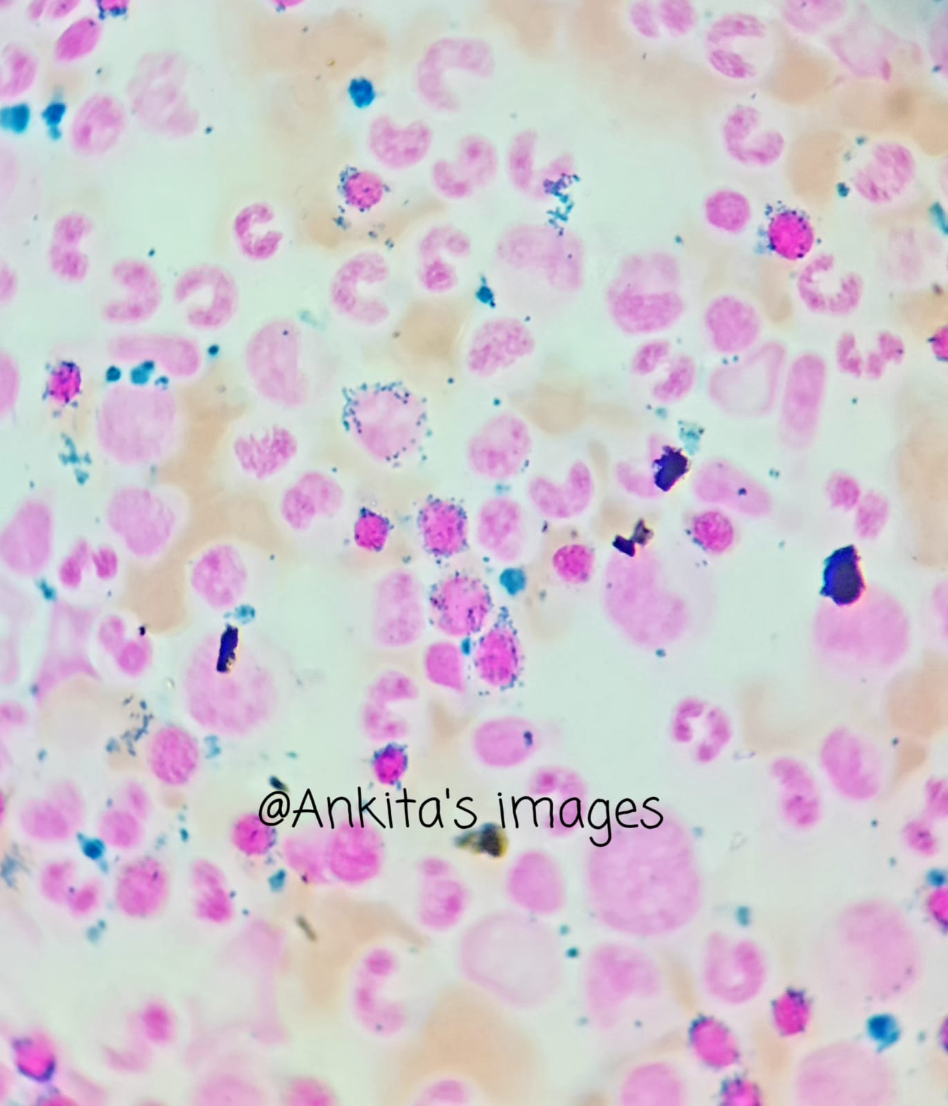 Prussian Blue Stain Sideroblastic Anemia Module Archives Page 14 Of