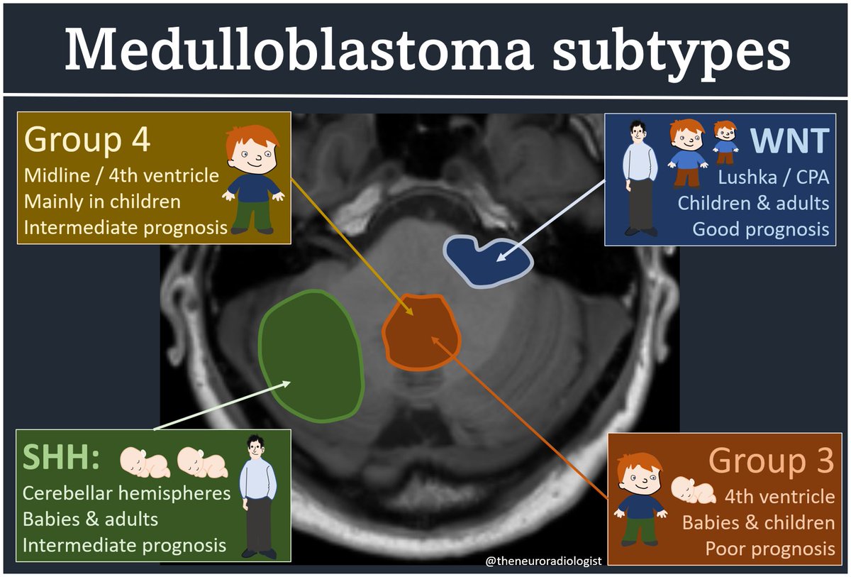 Medulloblastoma Radiology Advanced MRI Imaging For Medulloblastoma.