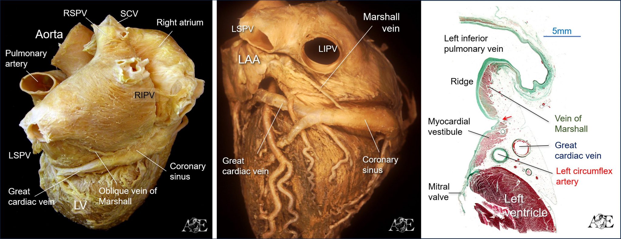 Pulmonary Veins Cadaver