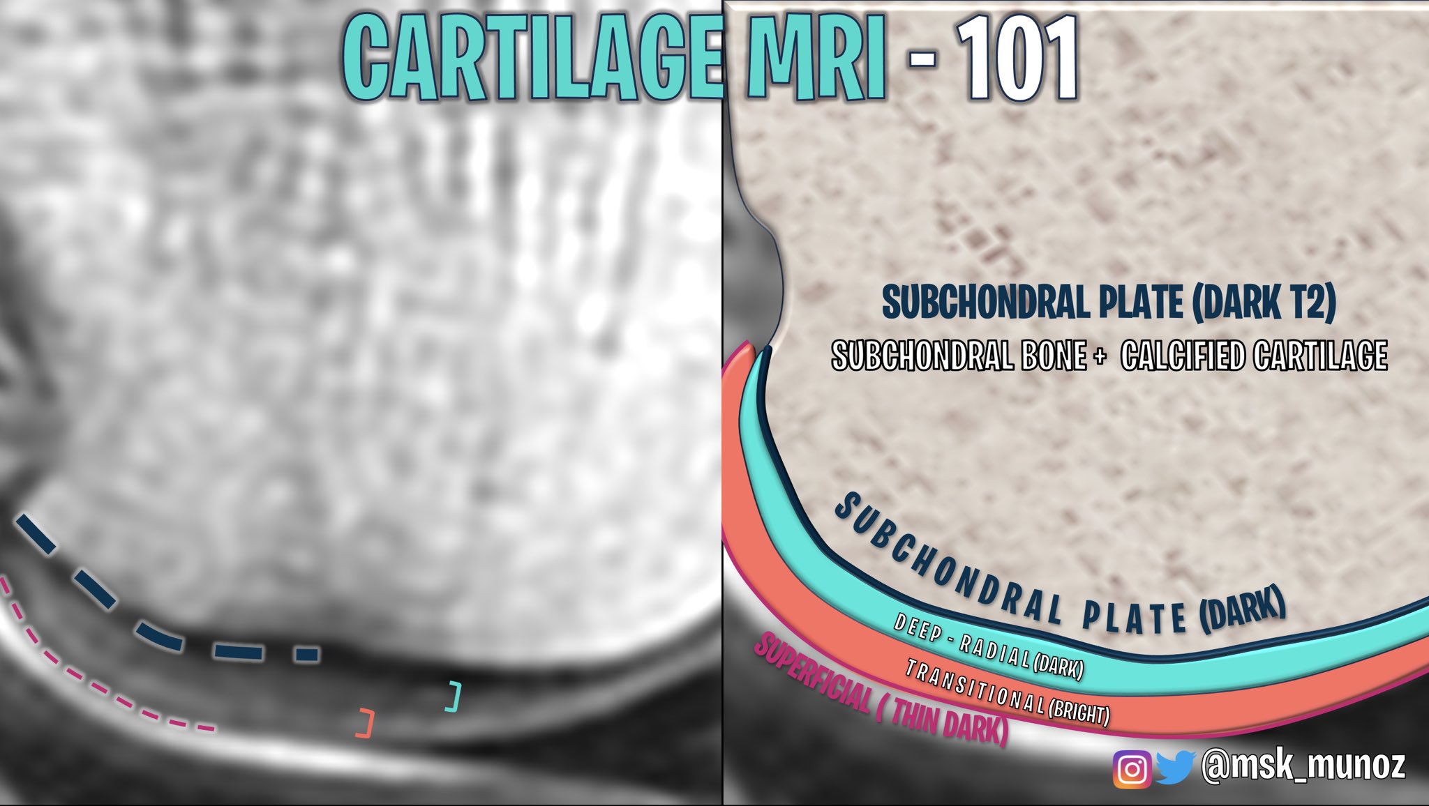 Subchondral Bone Plate A) Quantification Of Tibial Subchondral Bone