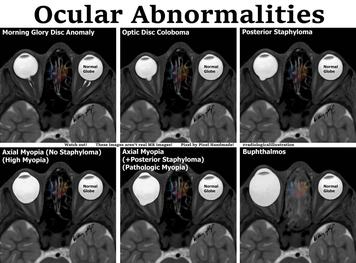 Coloboma Mri