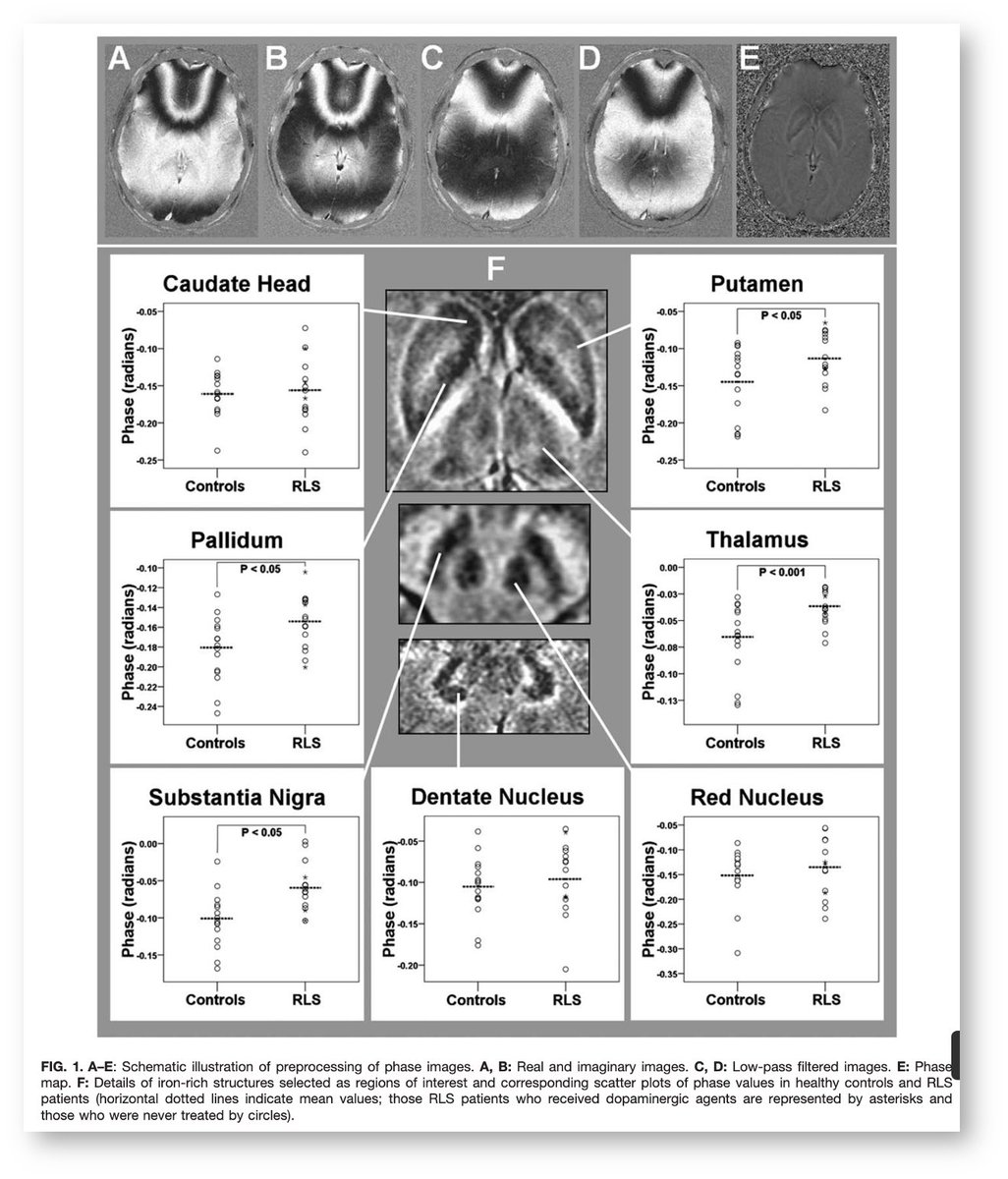 1/13 🤔Why does iron administration relieve symptoms of restless leg ...