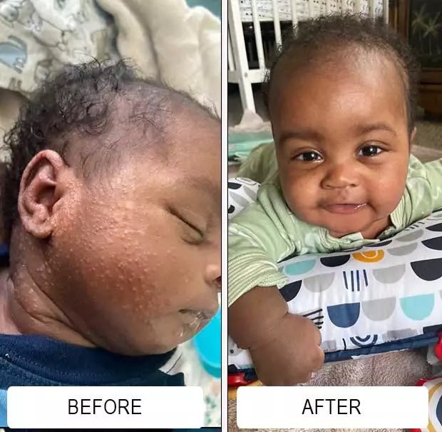 Cradle Cap Black Babies