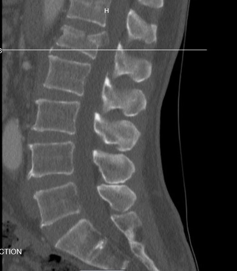 A Split In Spinous Process