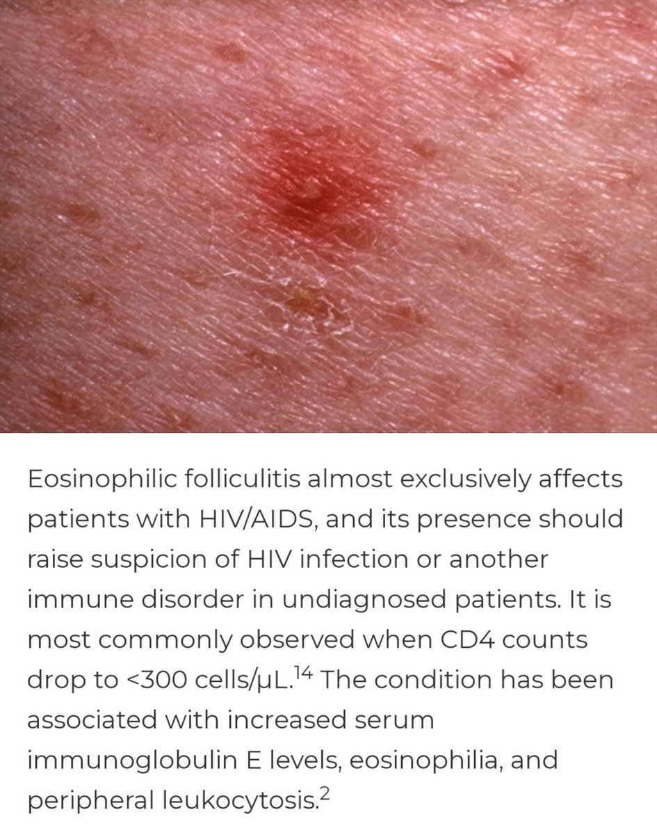 Eosinophilic Folliculitis Face