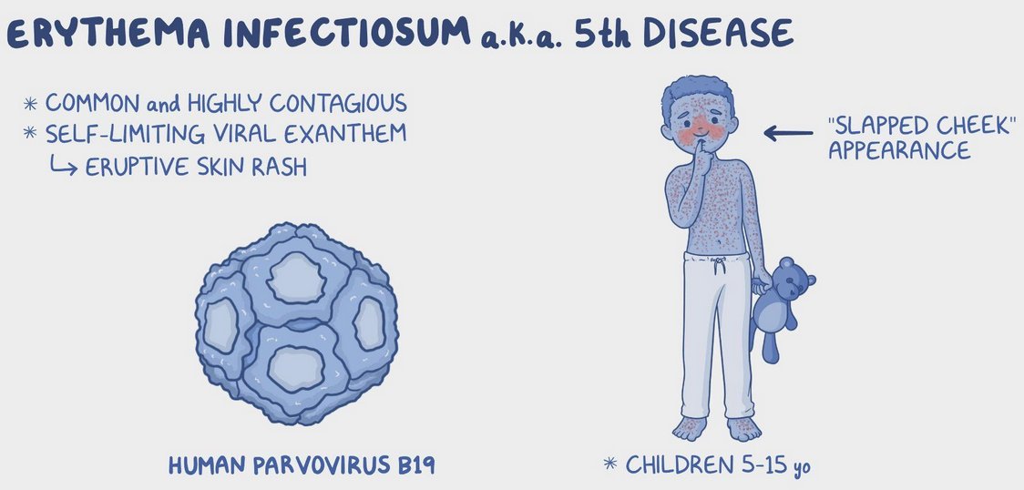Erythema Infectiosum Lacy Rash
