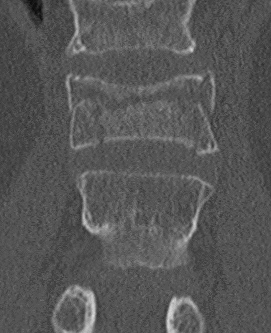 Distinguishing between pathologic & compression fractures can be ...