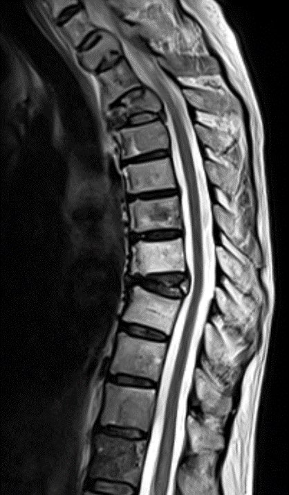 Distinguishing between pathologic & compression fractures can be ...