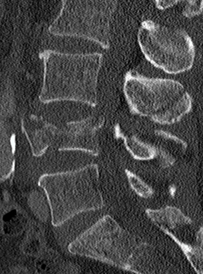 Distinguishing between pathologic & compression fractures can be ...