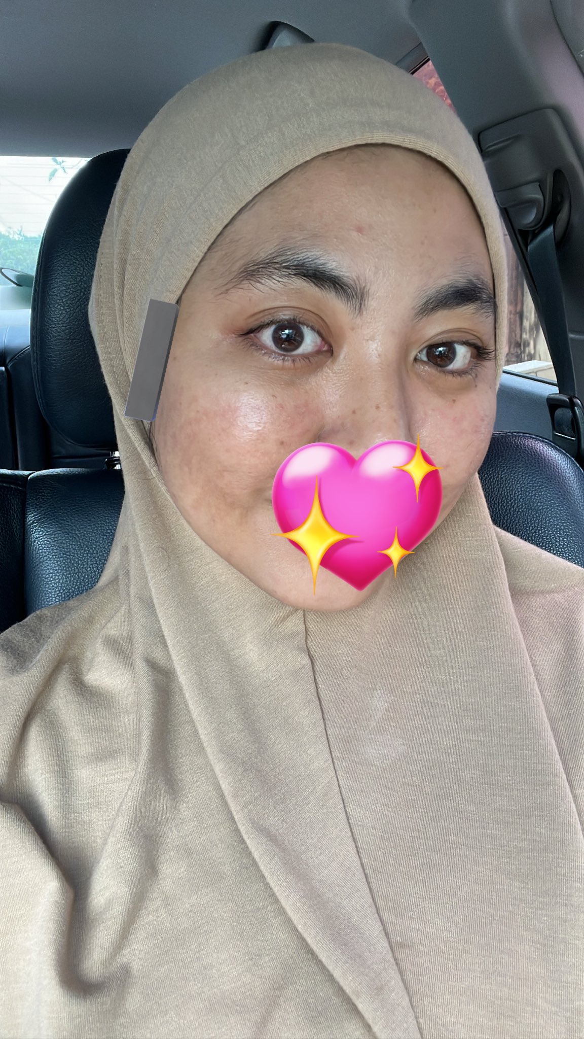 Tiya Niesh 🕊️ on Twitter: "Hari tu kulit I burn sebab laser. I buat laser untuk deep scars ...