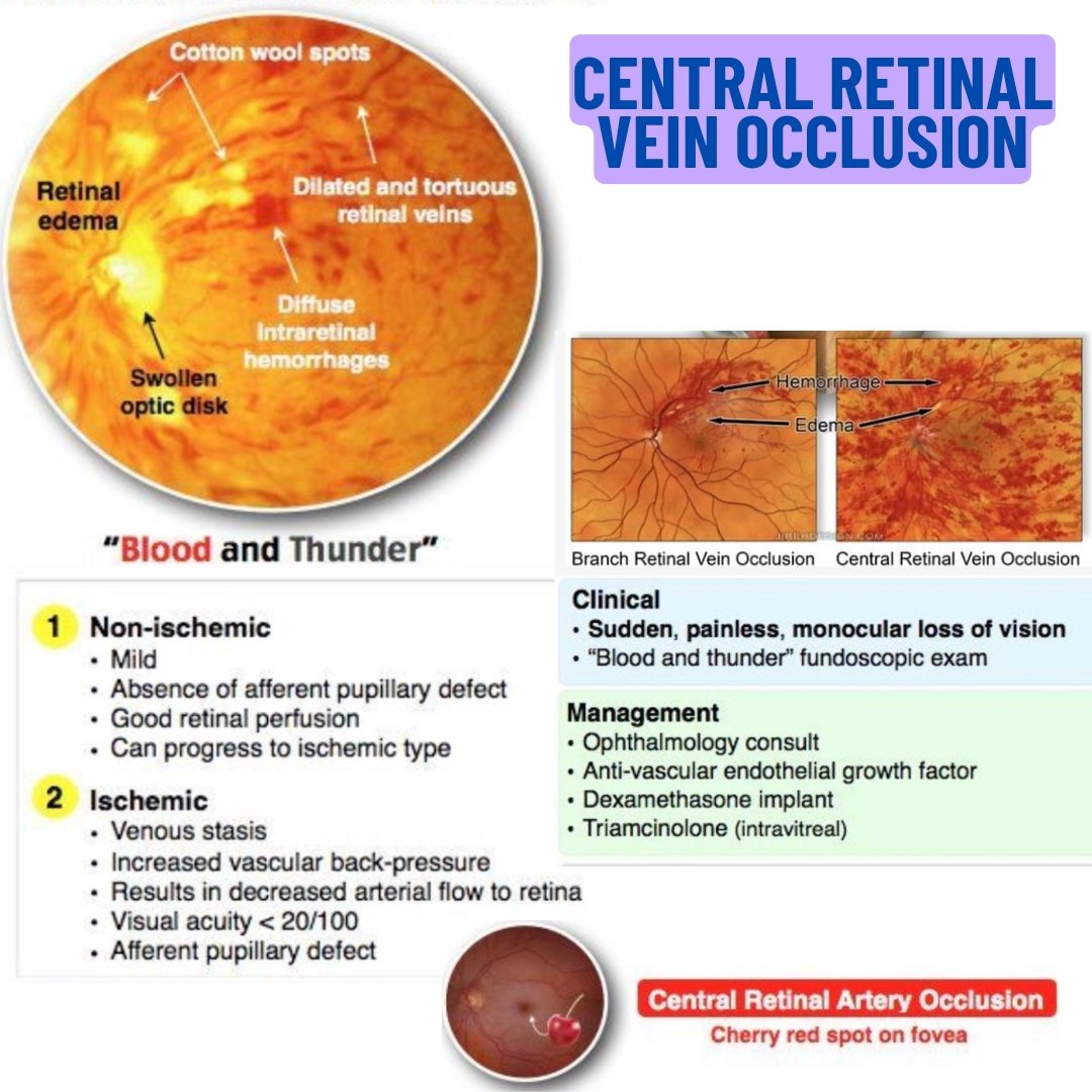 Ischemic Central Retinal Vein Occlusion