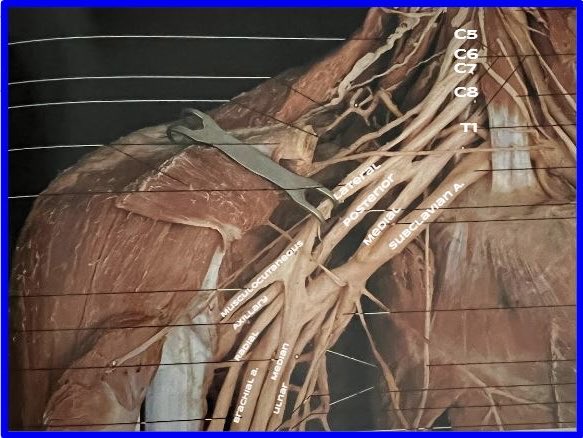 Brachial Plexus Cadaver Labeled Axilla And Arm Clinical Tree