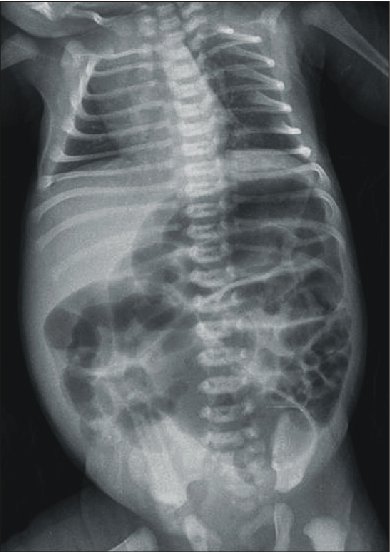 This newborn had abdominal distention and vomiting. Thoughts? - Thread ...