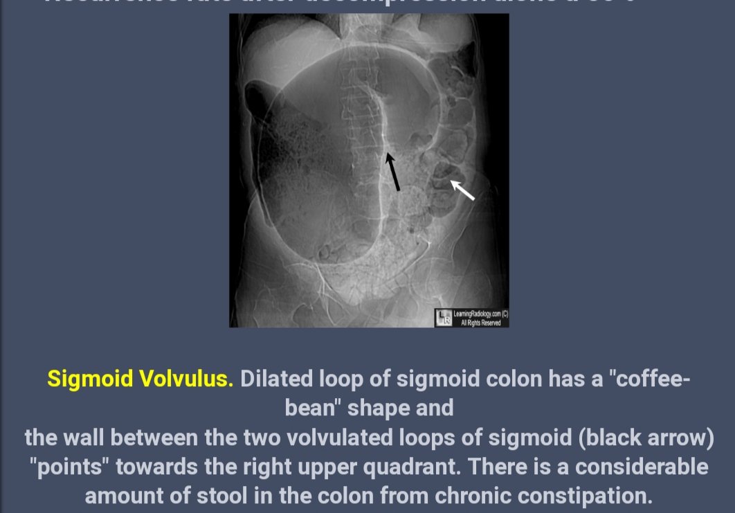Sigmoid Volvulus Coffee Bean Sign