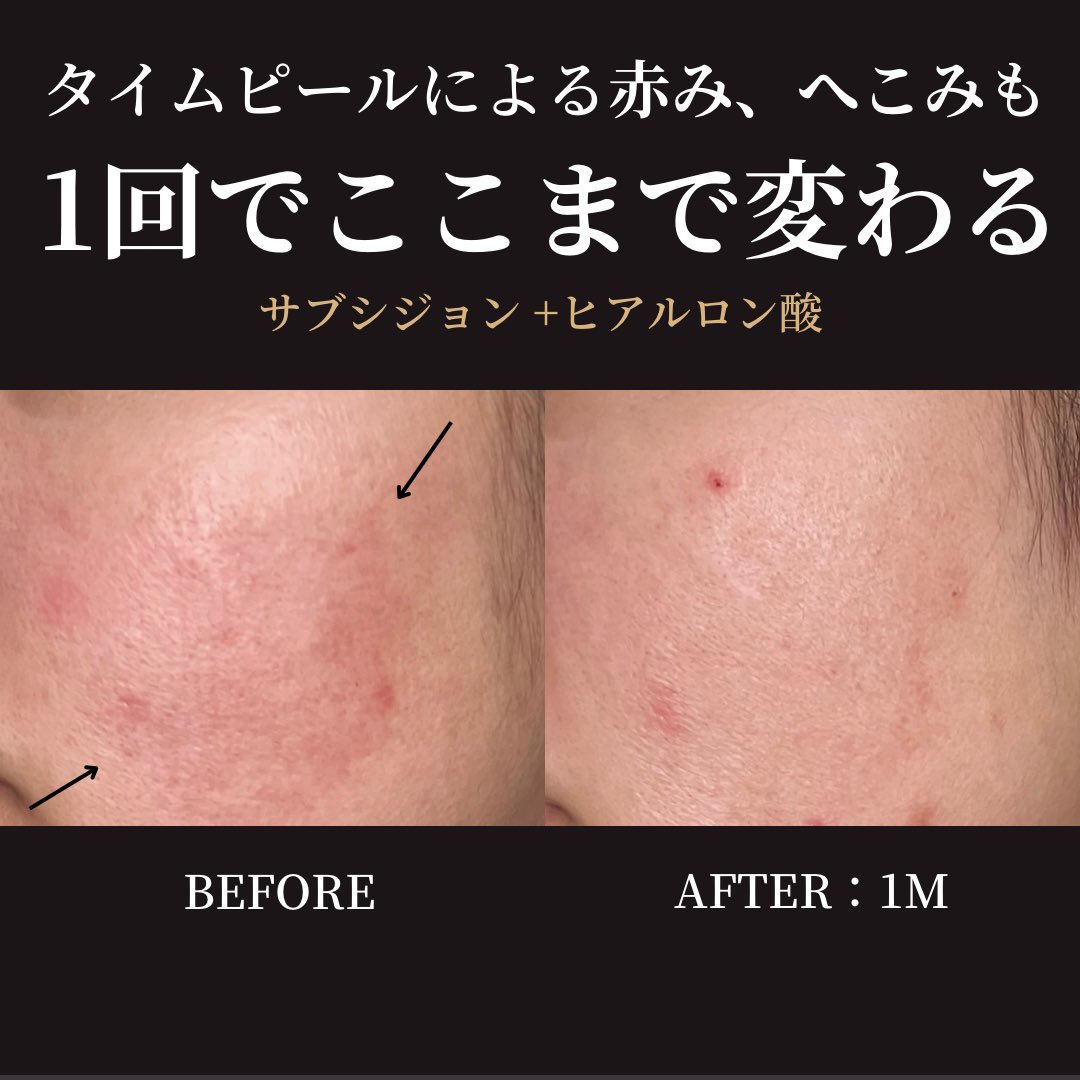 グランメドクリニック茨木 院長岡田大輔 On Twitter 当院でサブシジョン、ヒアルロン酸を受けられた患者様です。他院様でタイムピールを受けられて赤みとへこみが残ってしまい当院へ来られ
