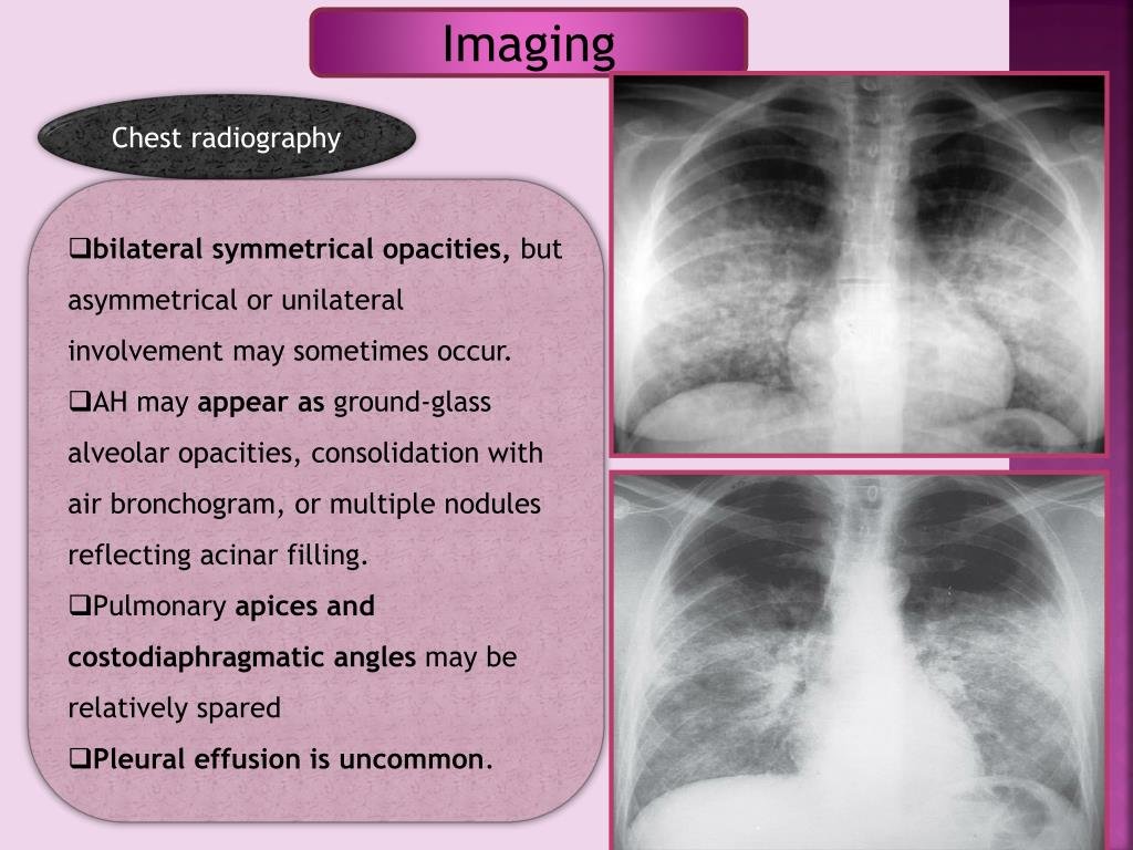 😢Lost a dear patient early in training to this severe complication😢 ...