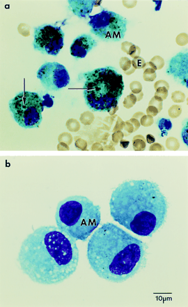 😢Lost a dear patient early in training to this severe complication😢 ...
