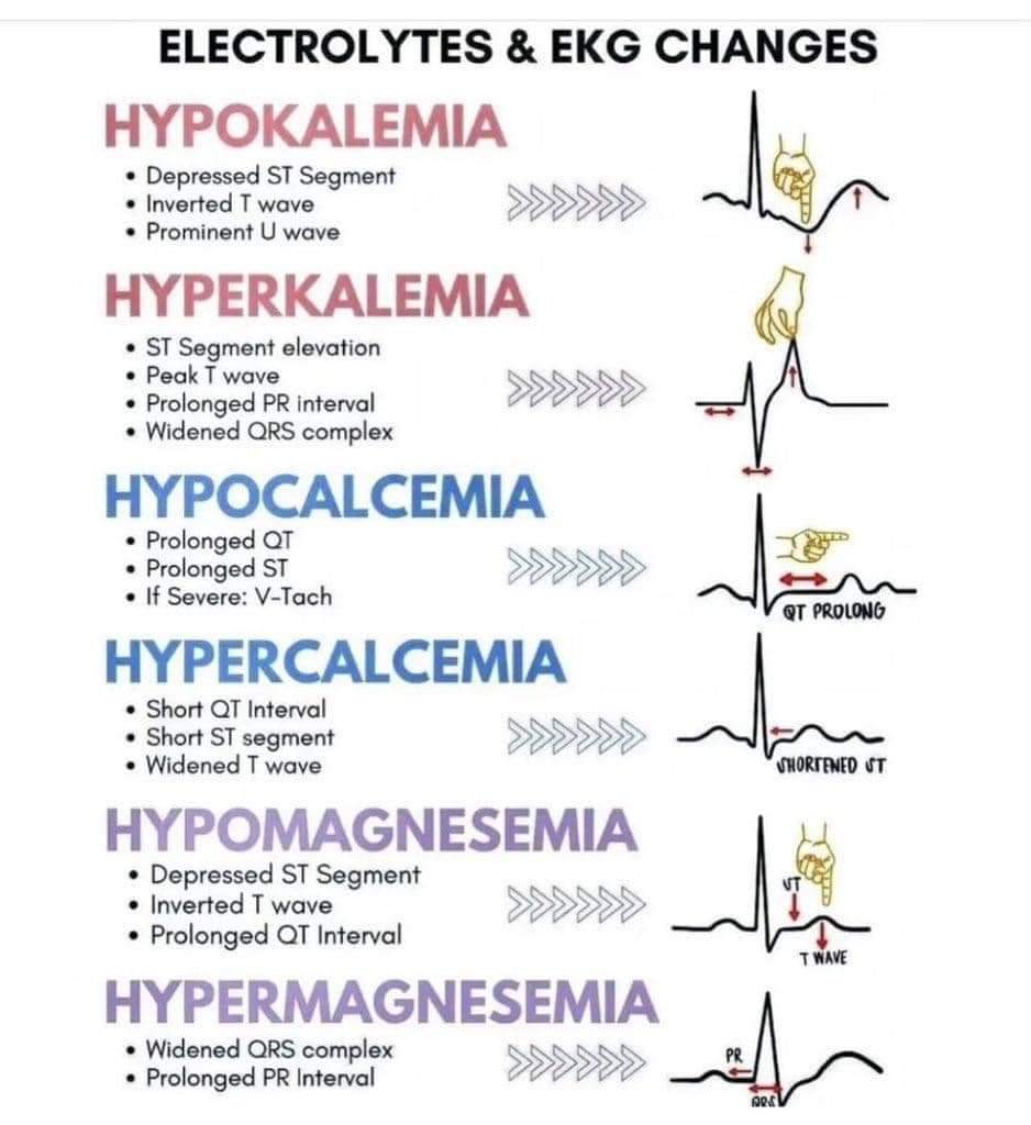 Hypocalcemia Ecg
