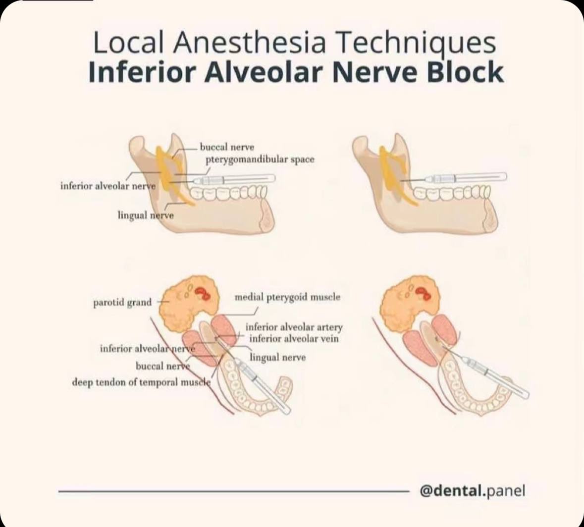 Inferior Alveolar Nerve Block Local Anesthesia Technique JaypeeDigital