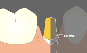 When you are planning to crown a tooth or replacing a missing tooth ...