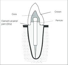 When you are planning to crown a tooth or replacing a missing tooth ...