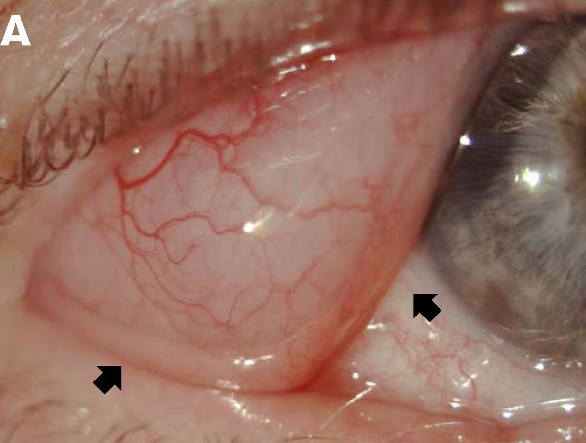 Periorbital edema -common complaint in patients treated with imatinib ...