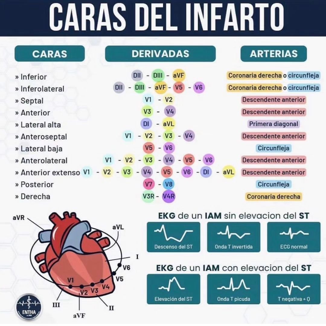 Electrocardiograma Infarto