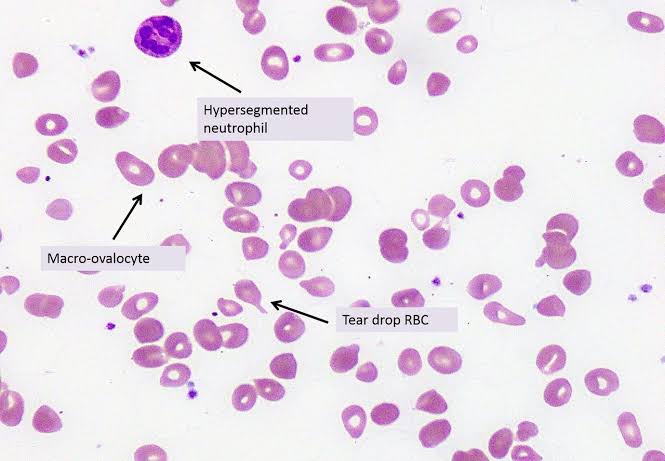 Ovalocyte